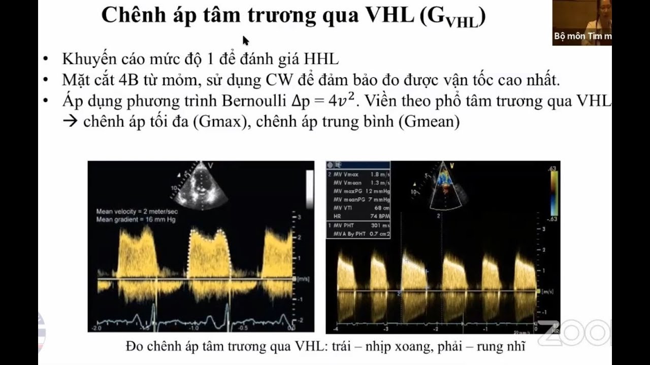 #06 Siêu âm tim trong bệnh hẹp van tim 2 lá. ThS. BS. Trần Hải Yến ...