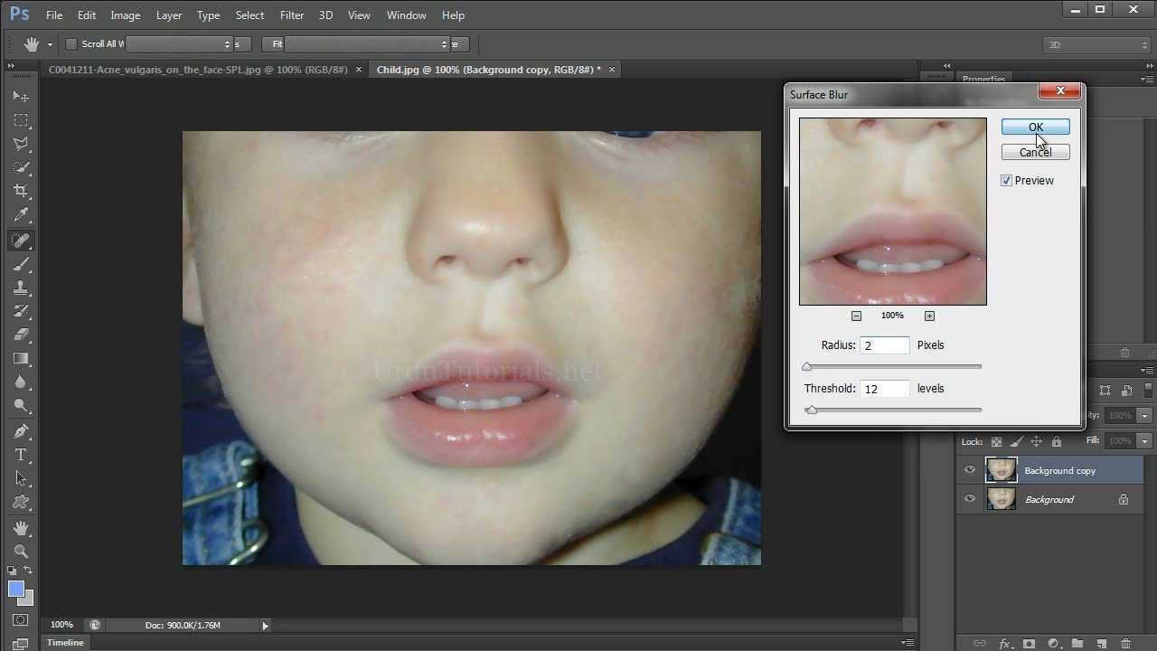 How To Remove Pimples From Face In Photoshop - YouTube