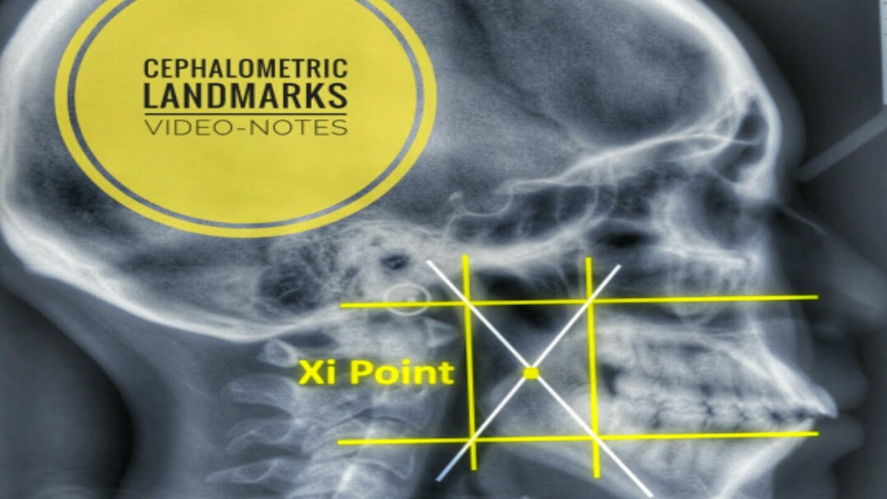 Cephalometric Landmarks and their definition - YouTube