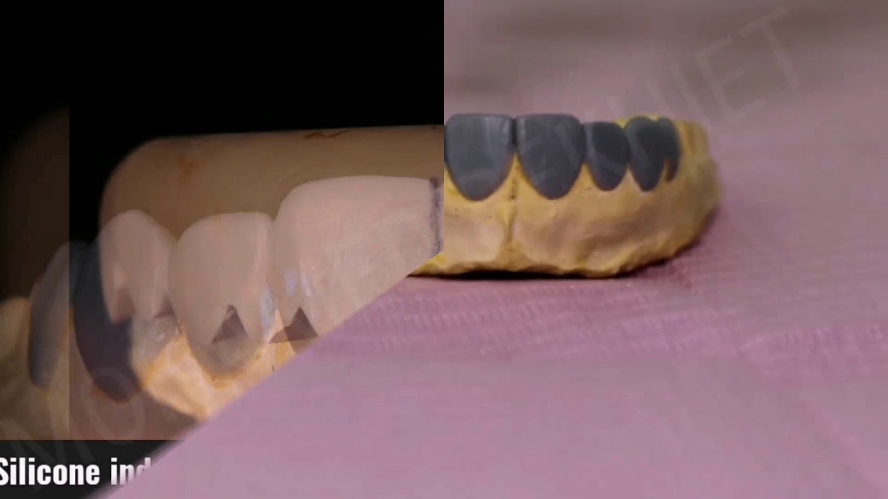 Silicone index and Mock up fabrication - YouTube