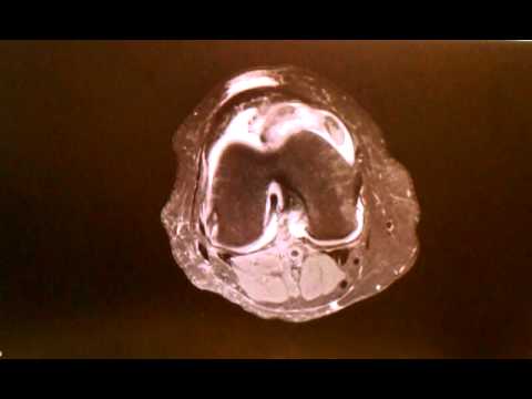 Mri 3 PVNS Pigmented Villonodal Synovitis - YouTube