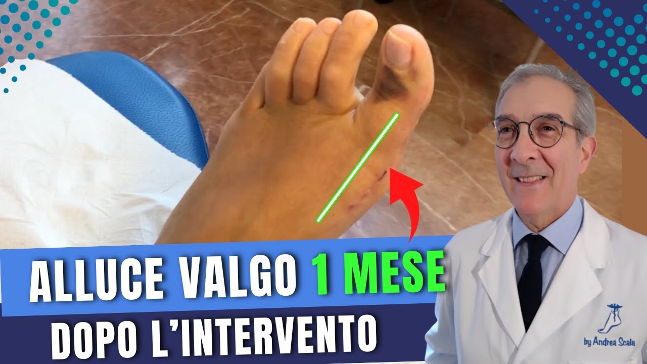ALLUCE VALGO 1 MESE DOPO L'INTERVENTO | Tecnica Dott. Andrea Scala ...