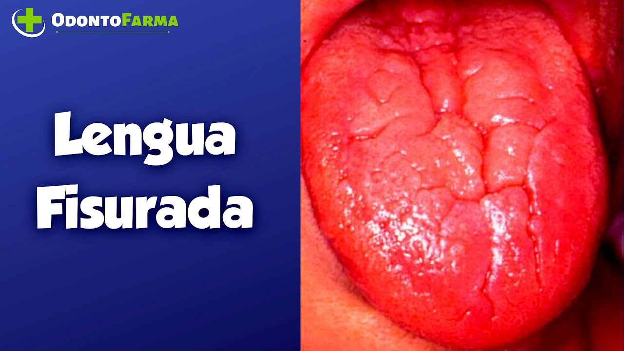 Lengua Fisurada - Características anatómicas o anomalías del desarrollo ...