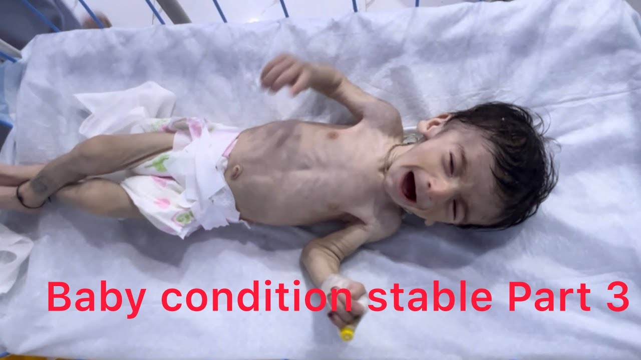 Nutritional Deficiency Baby–Part 3 Condition Improved & Feeding Well ...