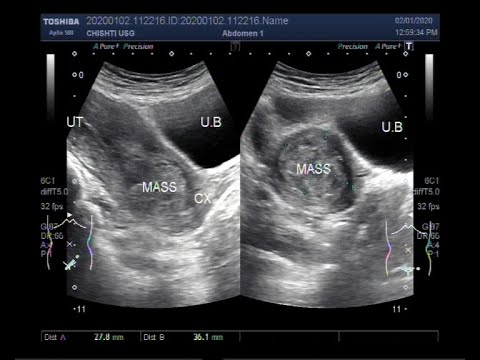 Ultrasound Video showing a mass in the cervix of the uterus. - YouTube