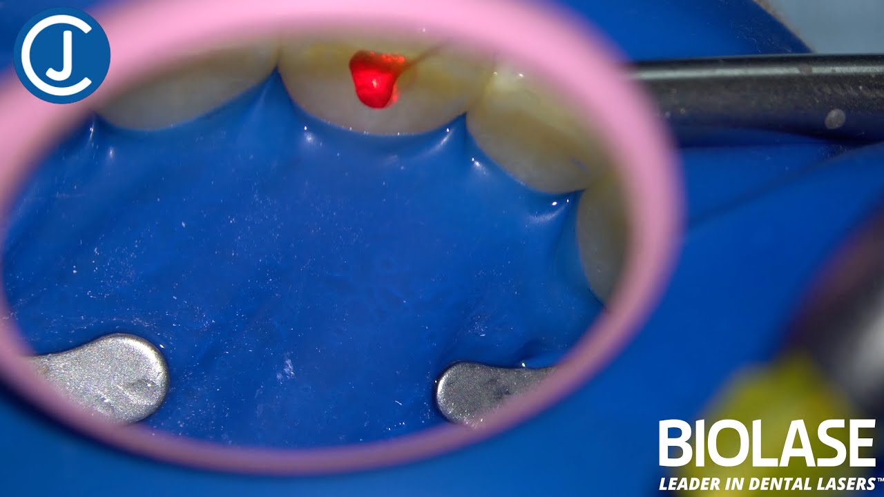 Necrotic root canal treatment - YouTube
