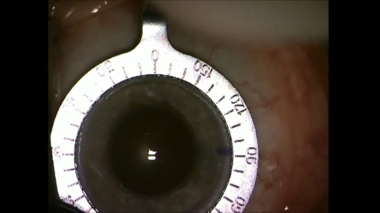 Phacoemulsification: Limbal Relaxing Incision - YouTube