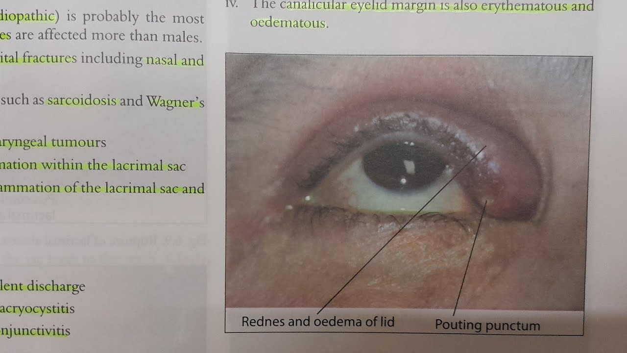 Acute Canaliculitis - EYE - YouTube