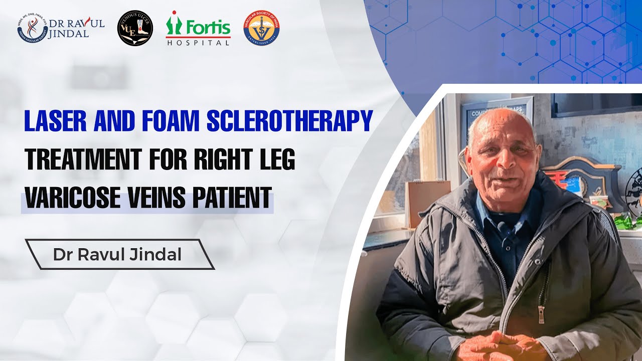 Laser and Foam Sclerotherapy Treatment for Varicose Veins Patient | Dr ...