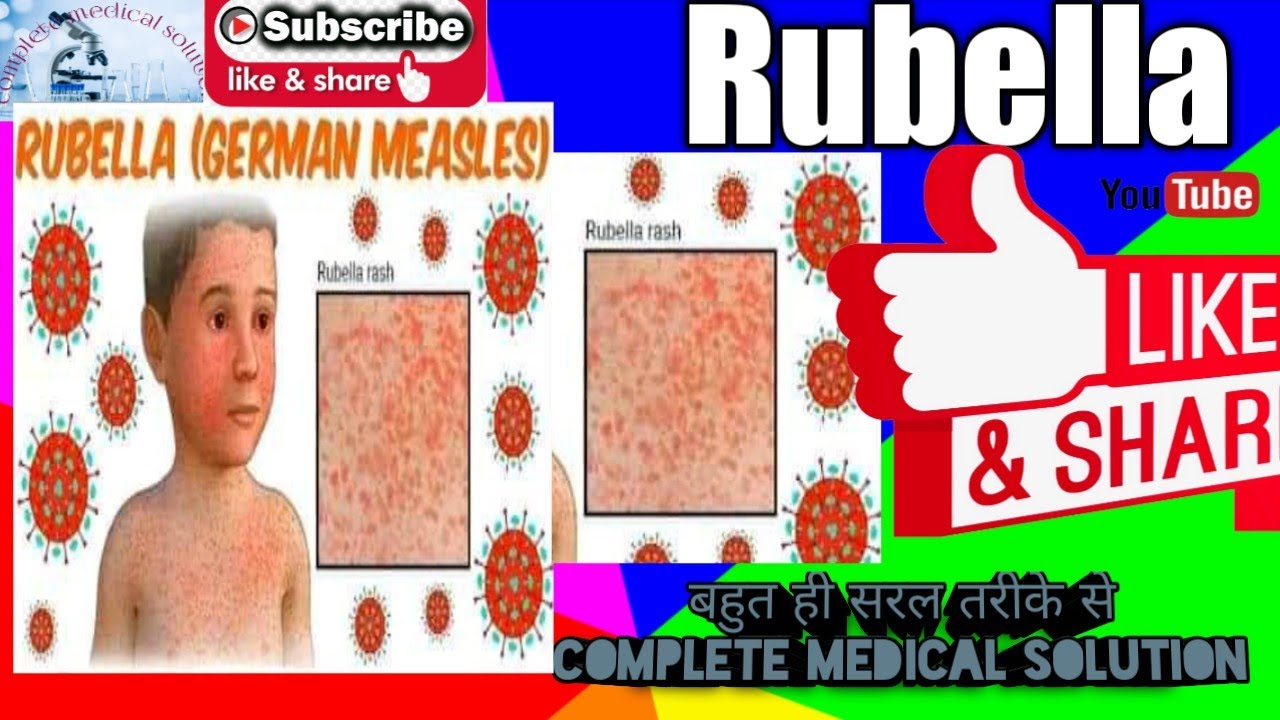 Rubella || Signs & symptoms ,tranmission of rubella,epidemiology ...