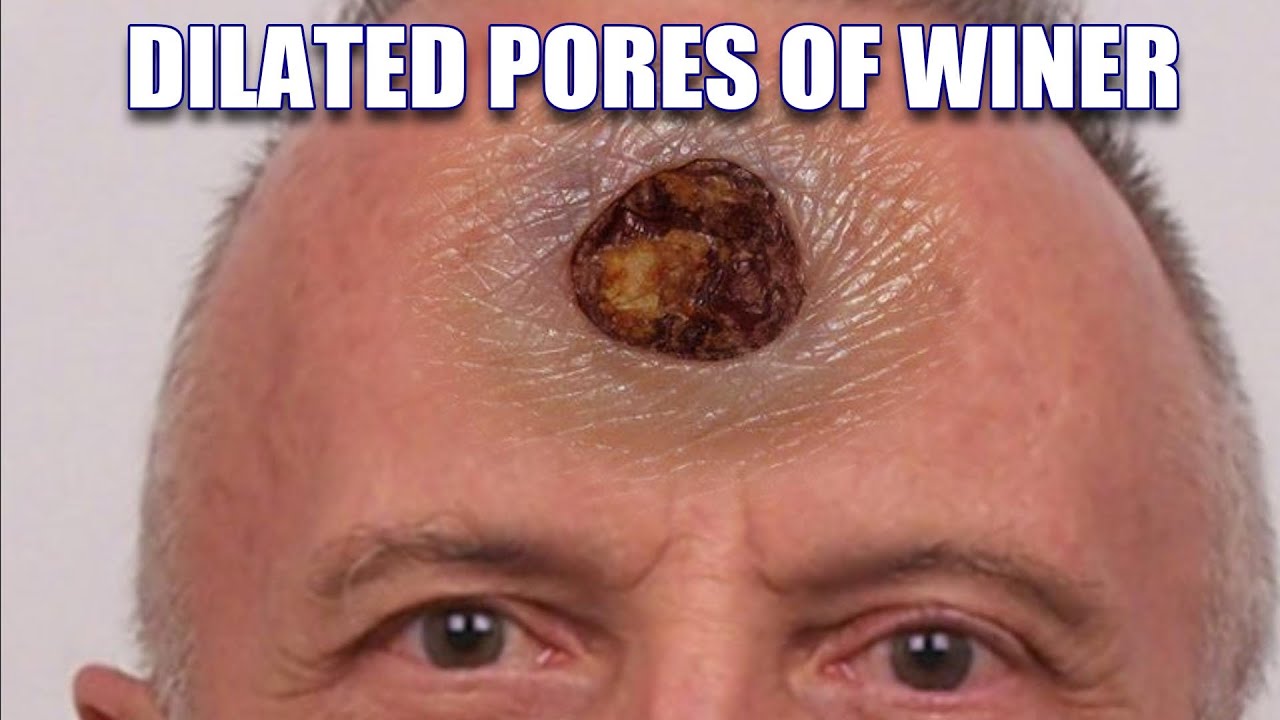 Top Five Dilated Pores of Winer! Comedone Extractor Tool Kit - YouTube