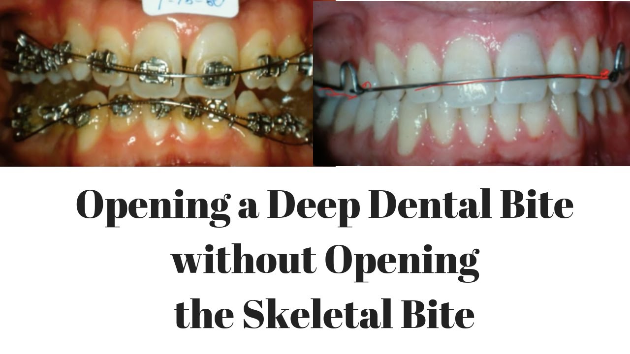 Opening a Deep Dental Bite without Opening the Skeletal Bite - YouTube