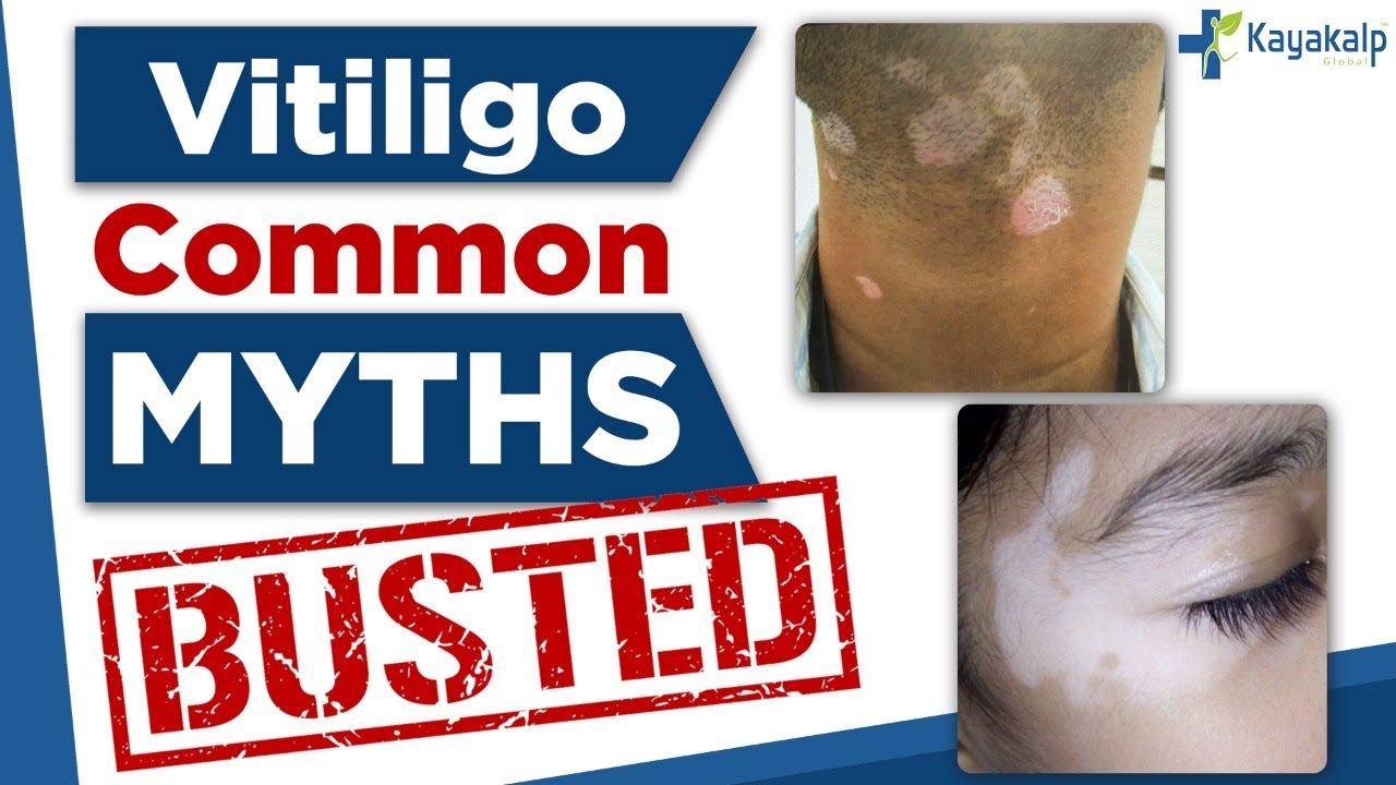 Myths About Vitiligo (सफ़ेद दाग) | Busting Common Myths And Facts About ...