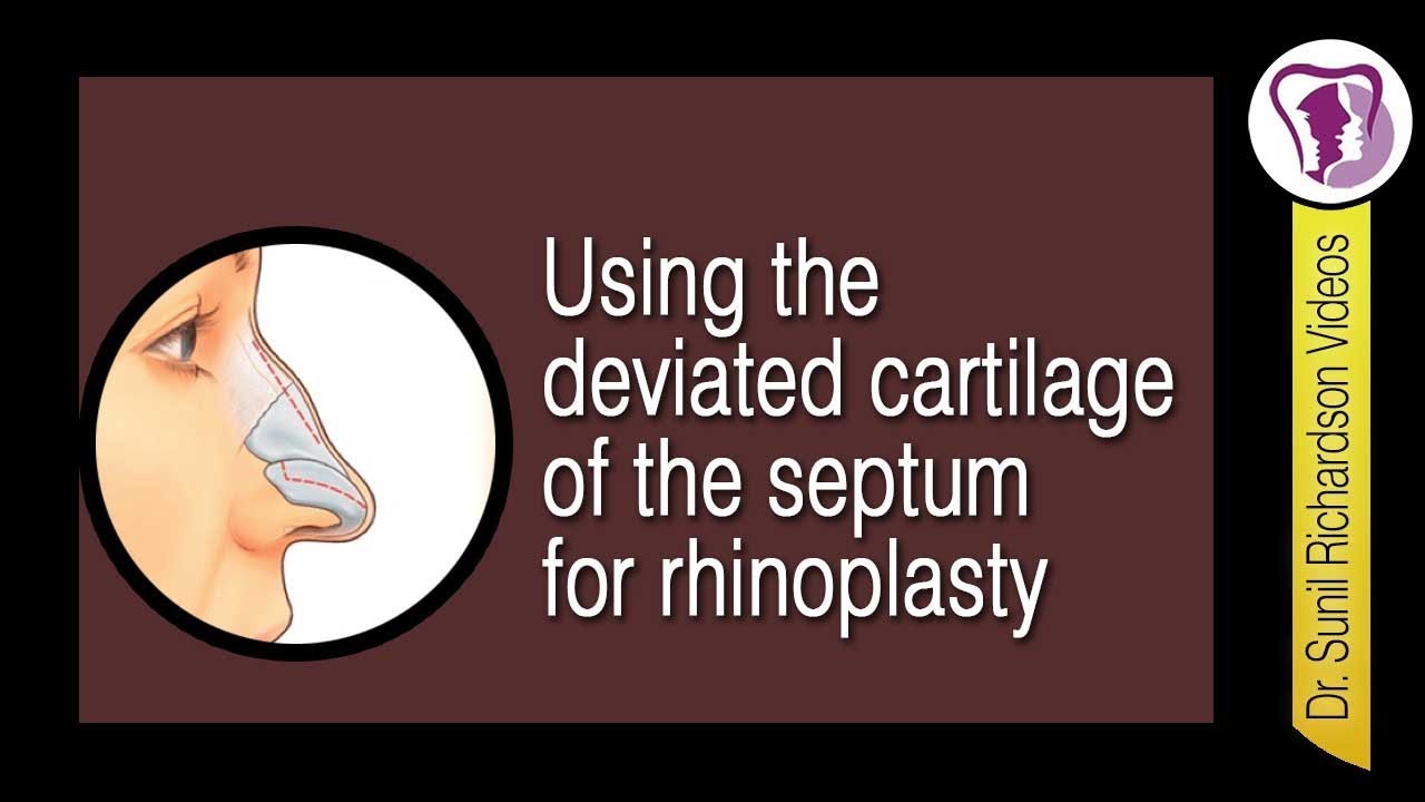 Using the deviated cartilage of the septum for rhinoplasty - Dr ...