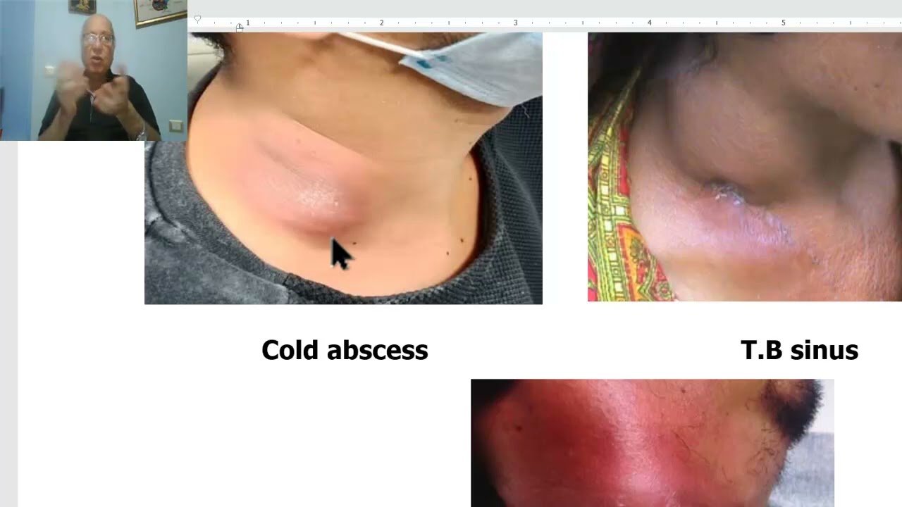 Lymphatic Disorders In Arabic 4 T B Lymphadenitis Part 2 By Dr