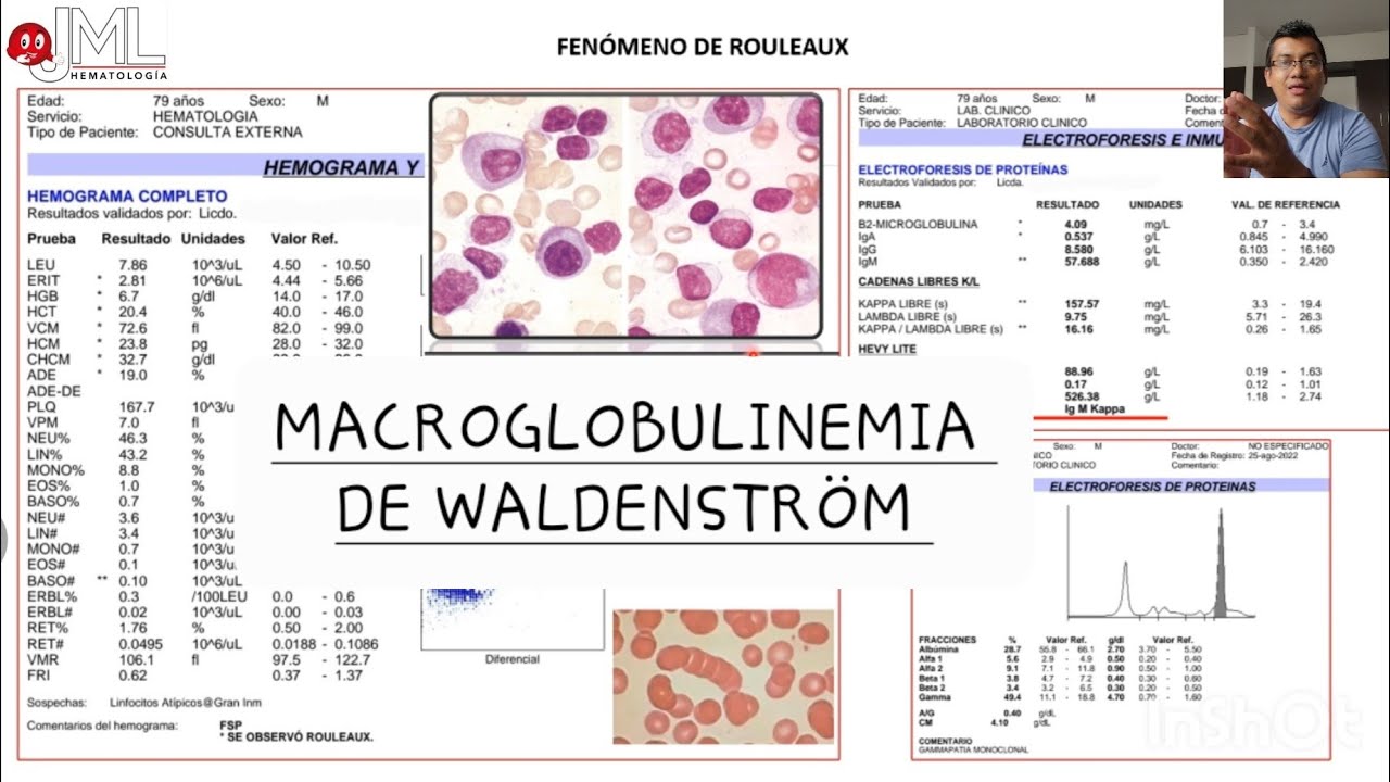 FENÓMENO DE ROULEAUX EN MACROGLOBULINEMIA DE WALDENSTRÖM - YouTube