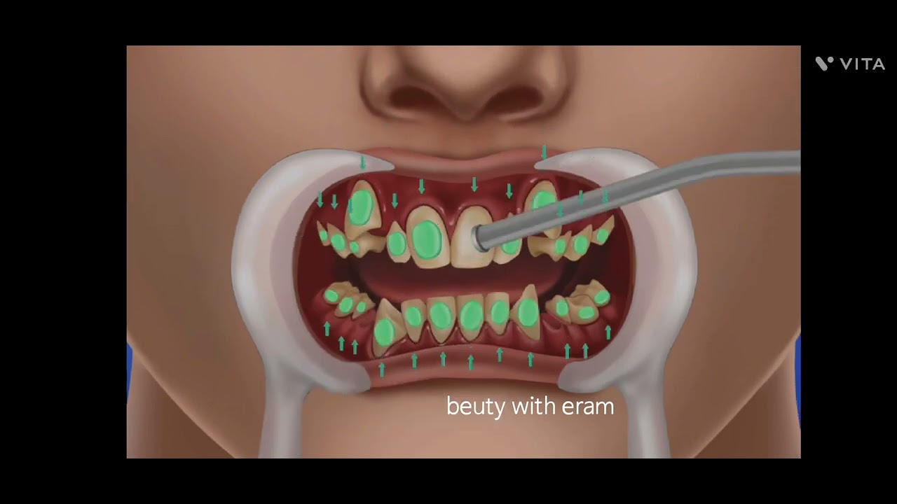best teeth shape ASMR #ASMR - YouTube