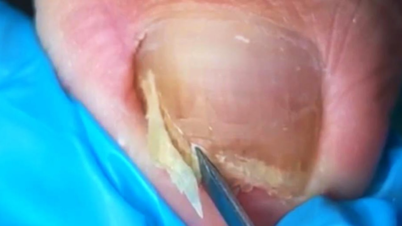 Super large ingrown nails easy to clean dead skin #Pedicure - YouTube