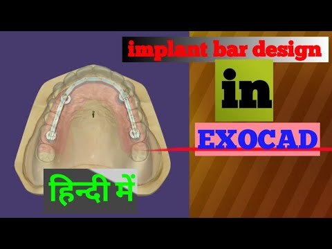 All on 4 implant bar design in exocad / implant bar design exocad / # ...
