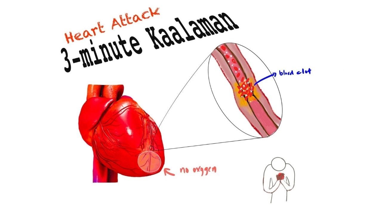 Kaalaman sa Atake sa Puso | Heart Attack Simple Explanation - YouTube