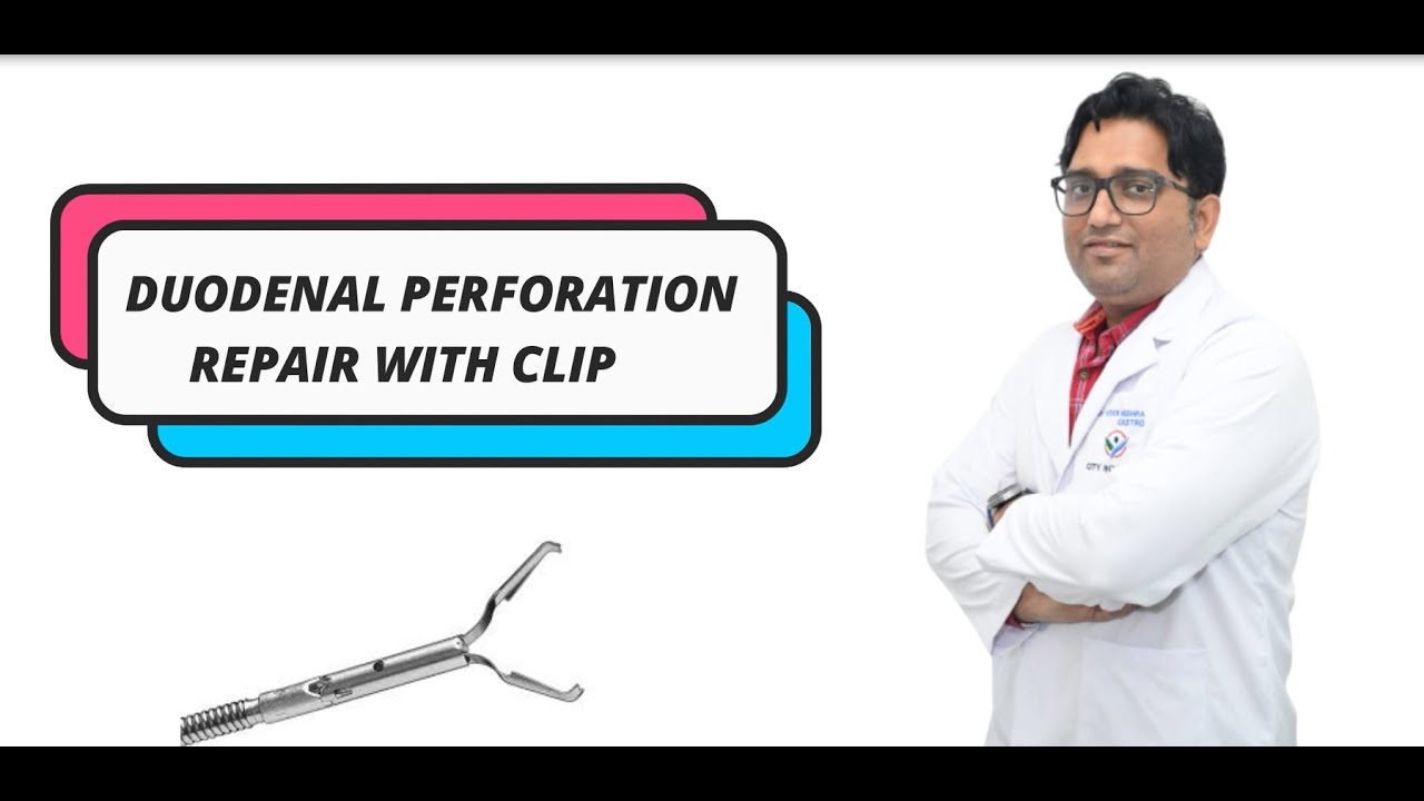 DUODENAL PERFORATION REPAIR WITH CLIP | ENDOSCOPY| - YouTube