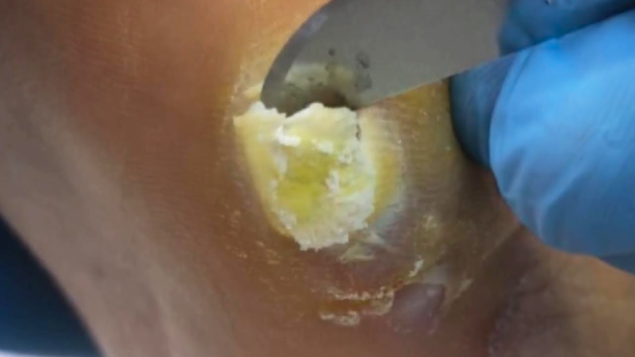 There Is A Yellow Bulge On The Sole Of The Foot, Which Has Been Treated ...