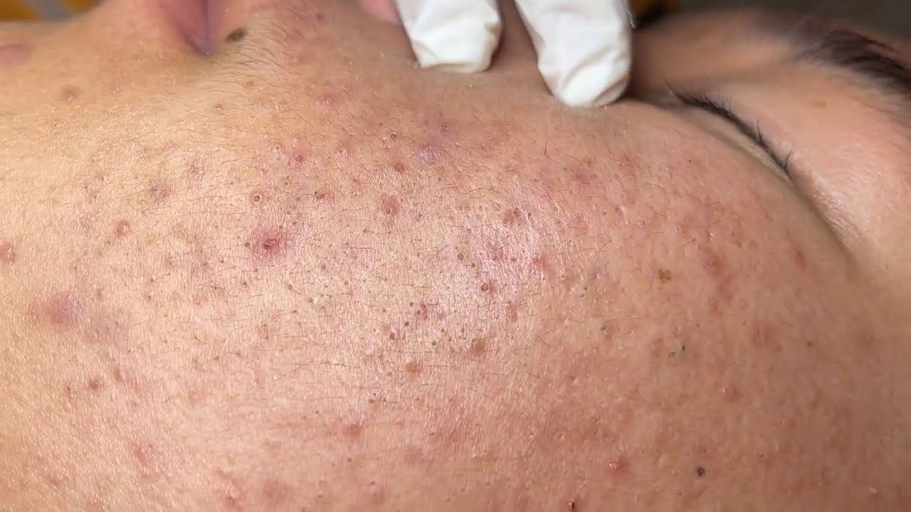 RELAXING WITH NASA SPA || SQUEEZE ACNE VIDEO #28 - YouTube