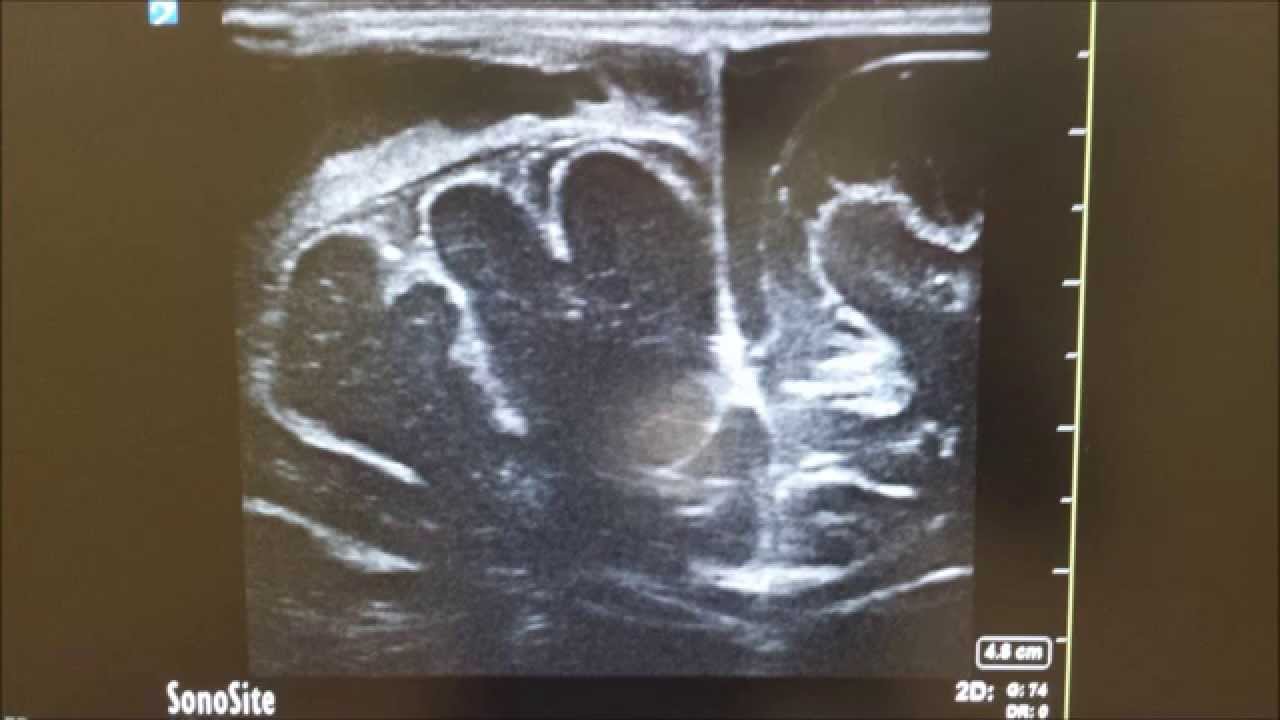 Transcranial ultrasound - YouTube