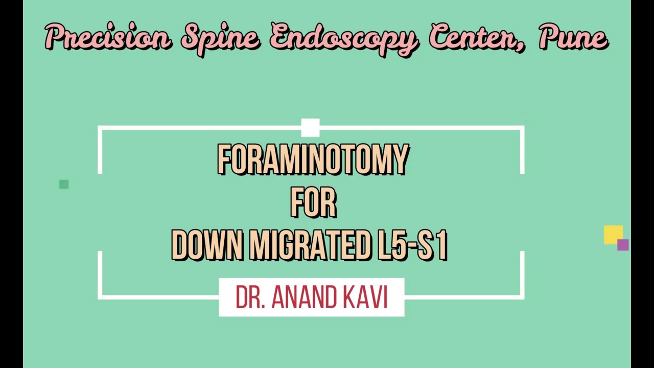 Foraminotomy for L5 S1 - YouTube