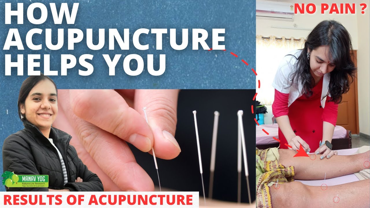 Acupuncture treatment | Get Pain Relief Quickly | Results of ...