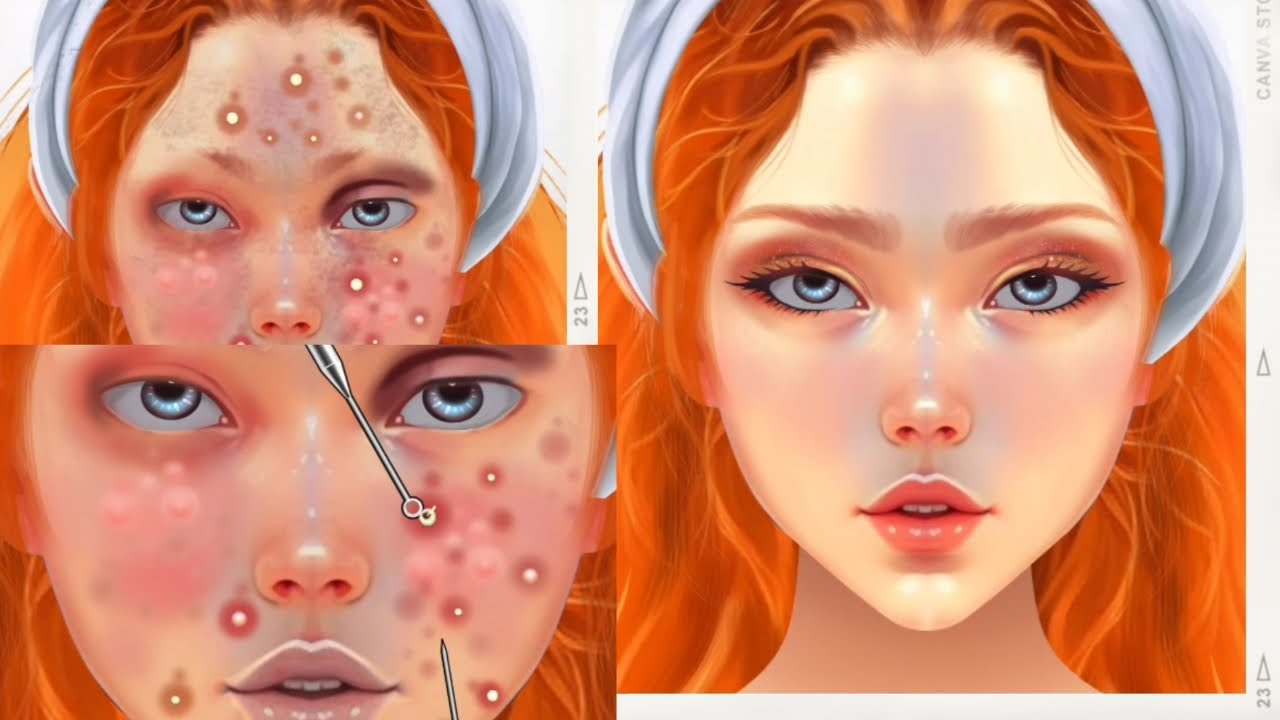 ASMR] Acne, Big Blackhead Removal Animation //Pimple Popping // Stop ...