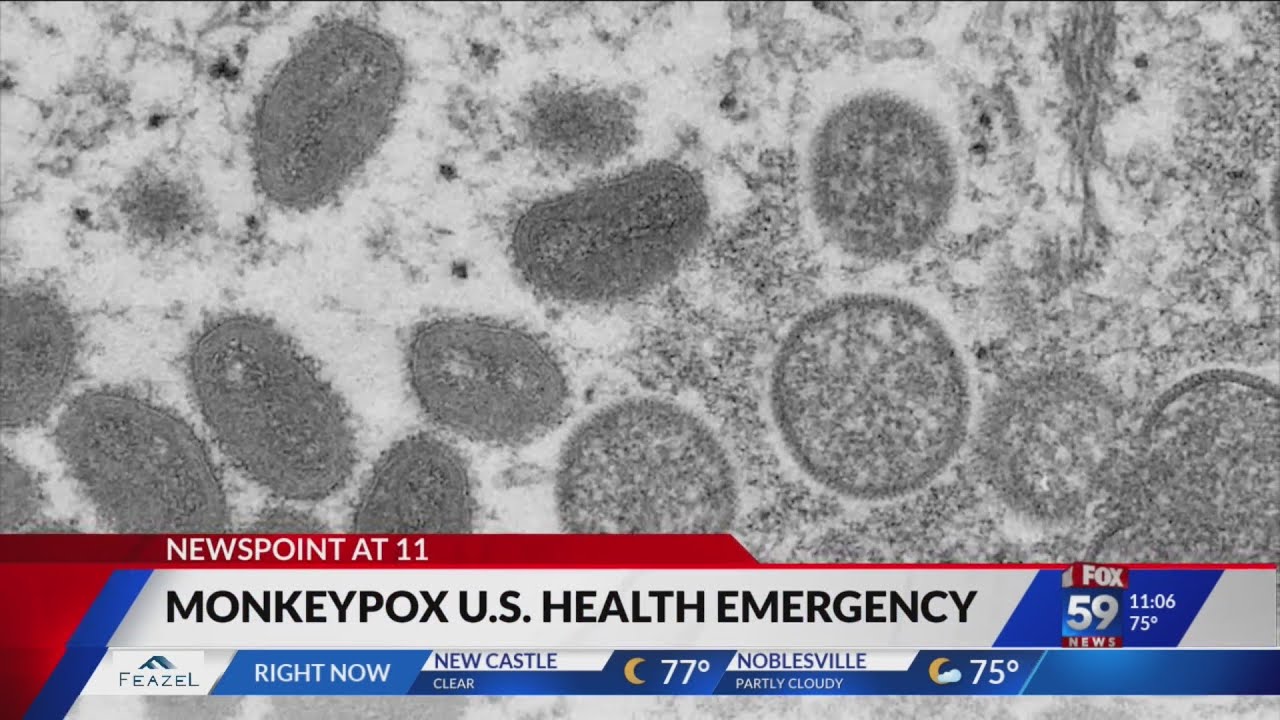 Experts weigh in on monkeypox virus in Indiana - YouTube