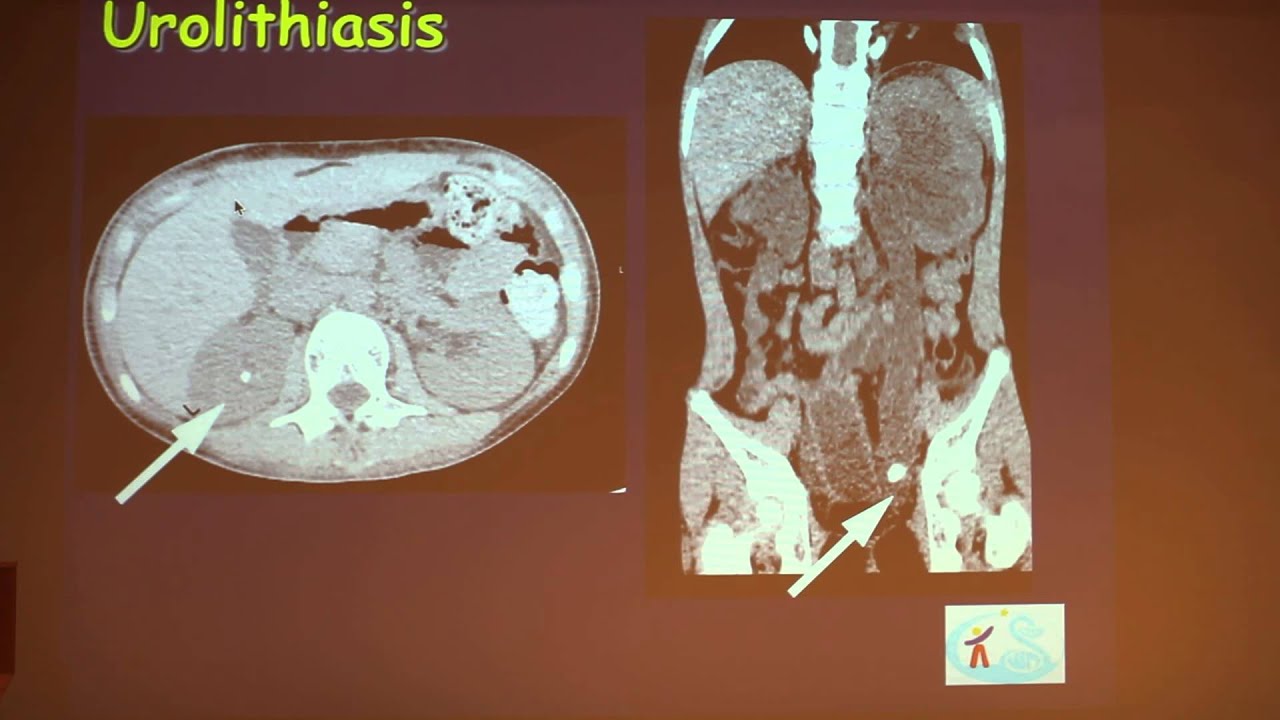 Pediatric Genitourinary Emergencies - Michalle SOUDACK Part 1 - YouTube