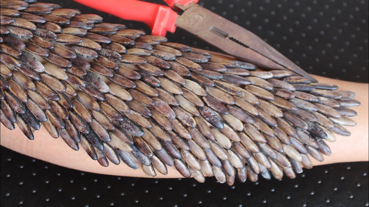 We Help Remove Small Leech On Leg Woman With Pliers That Worked 100% ...