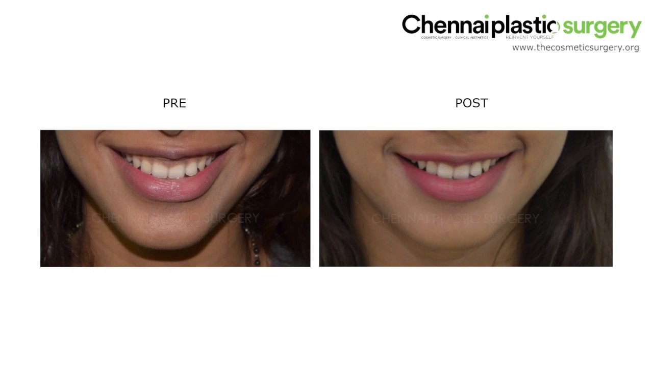 BOTOX FOR GUMMY SMILE CORRECTION AT CHENNAI PLASTIC SURGERY, INDIA ...