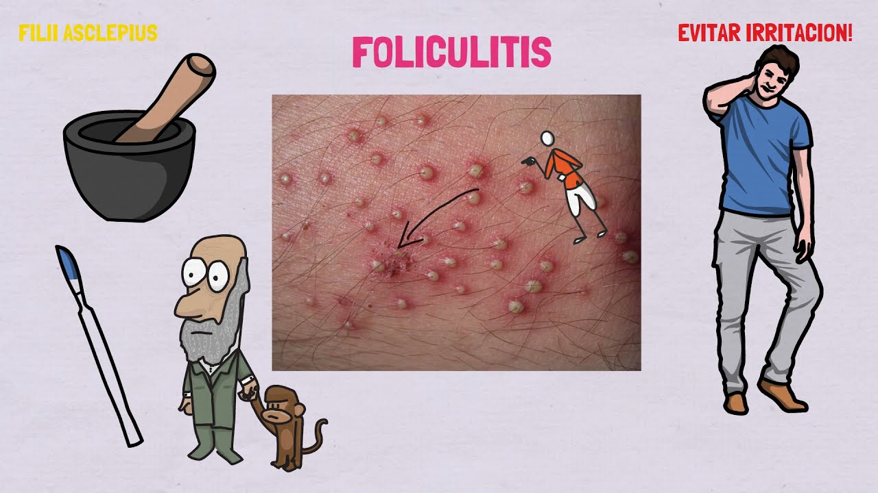 TRATAMIENTO PARA LA FOLICULITIS - YouTube