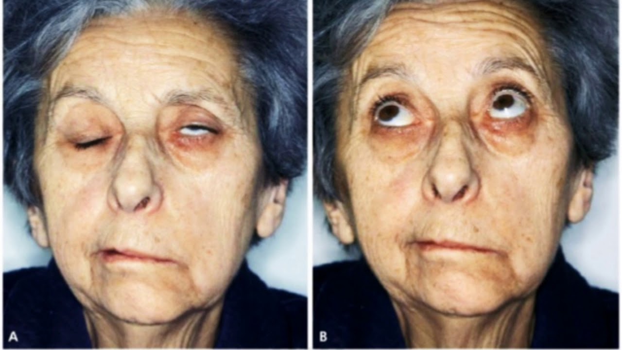 video para paciente paralisis facial (bell) - YouTube
