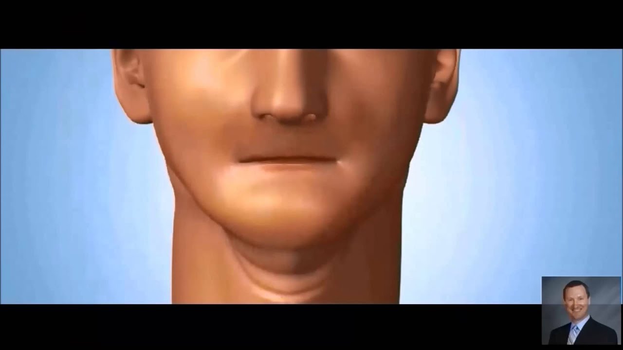 Male Facial Atrophy after Tooth Loss - YouTube