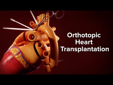 What Is An Orthopedic Heart Transplantation