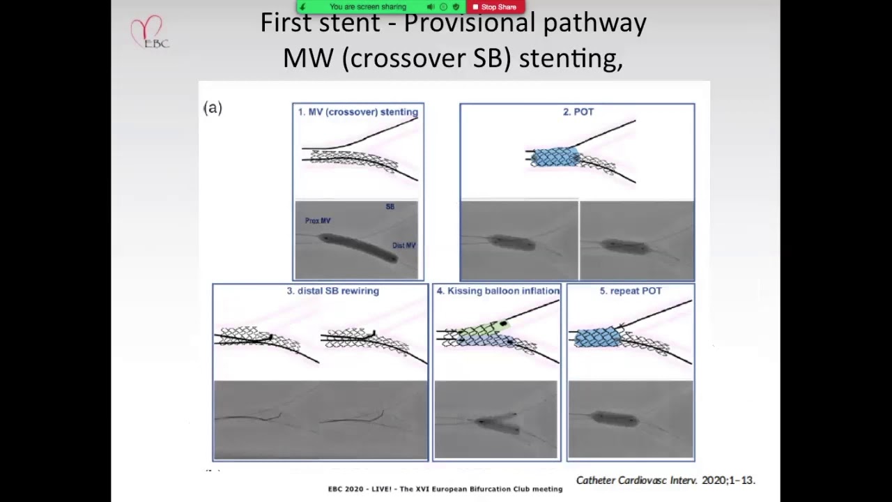 Why POT is so important in Left Main PCI - Dr Jens Flensted Lassen ...