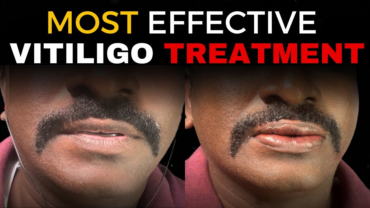Vitiligo cure a unique treatment | Permanent solution | Machu Tattoos ...