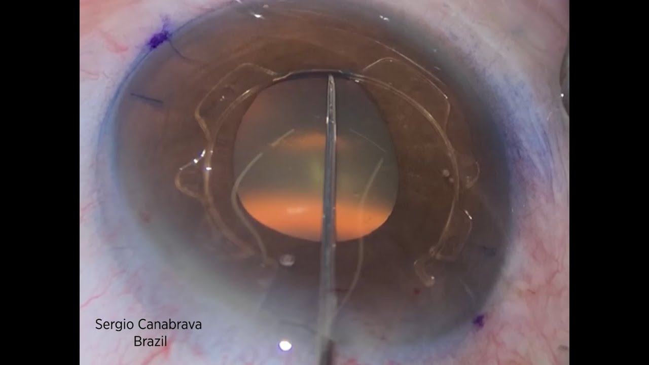 CANABRAVA RING + Toric IOL - YouTube