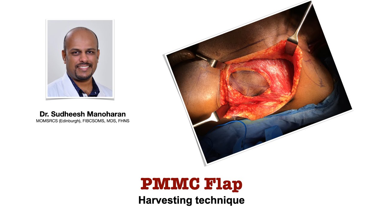 PMMC flap/Dr. Sudheesh Manoharan - YouTube