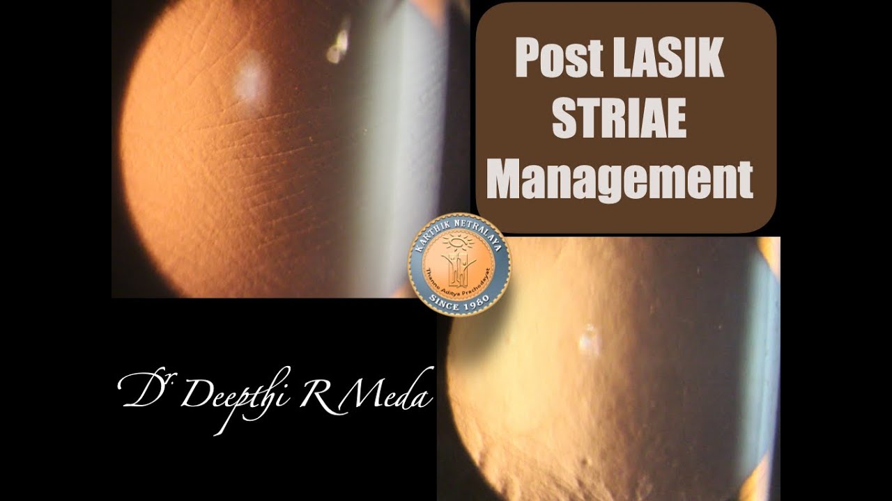 Management of Post LASIK Striae by Dr.Deepthi R Meda, Karthik Netralaya ...