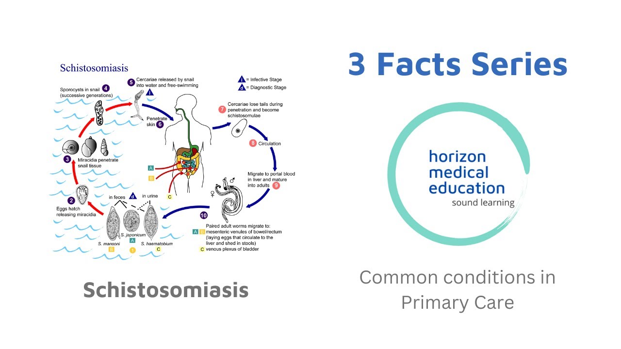 Schistosomiasis | Bilharzia | Snail fever - YouTube