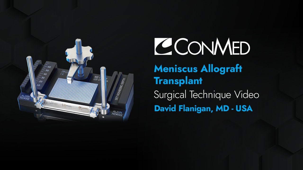 Dr. David Flanigan - Meniscus Allograft Transplant - CONMED Surgical ...