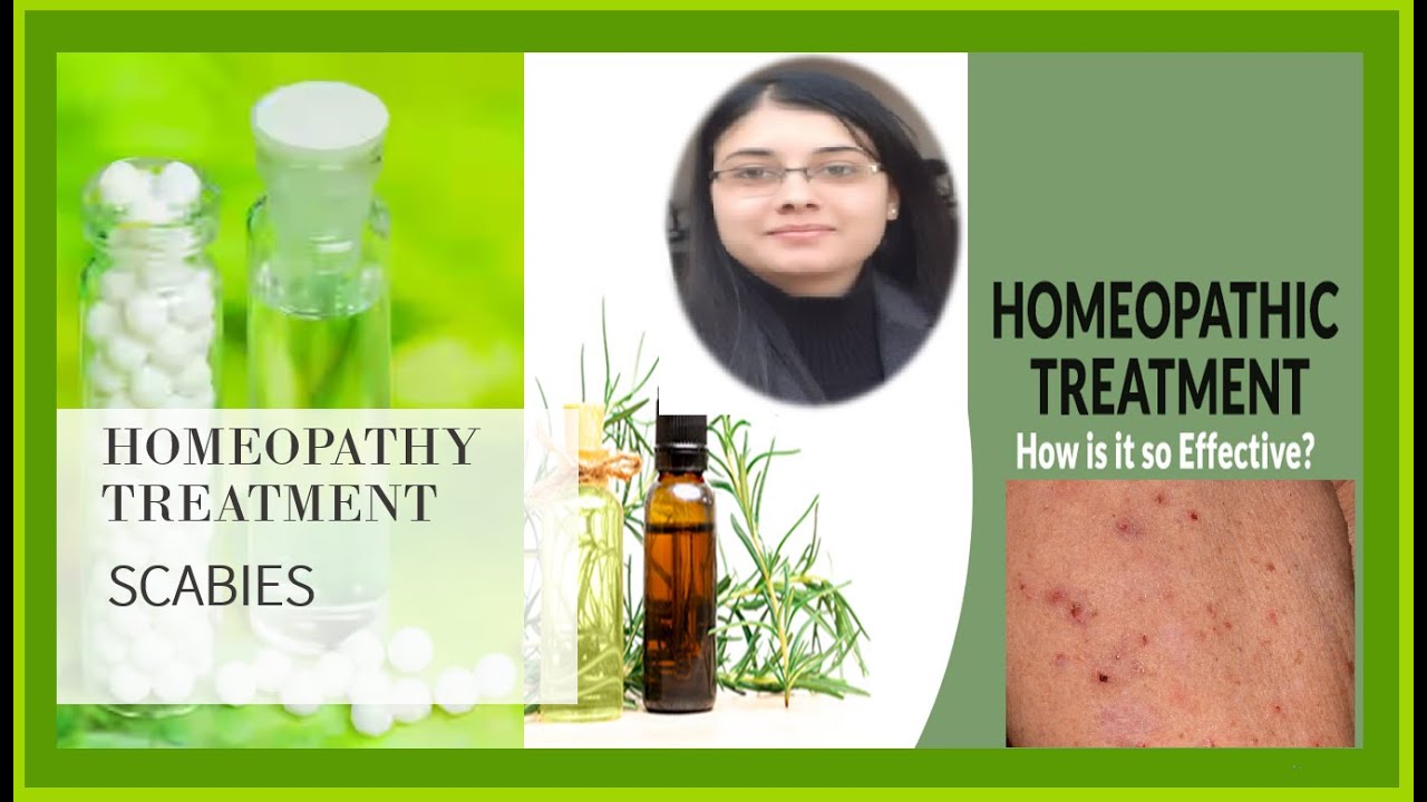 SCABIES || Homeopathic Medicines for Scabies || Severe Itching ...