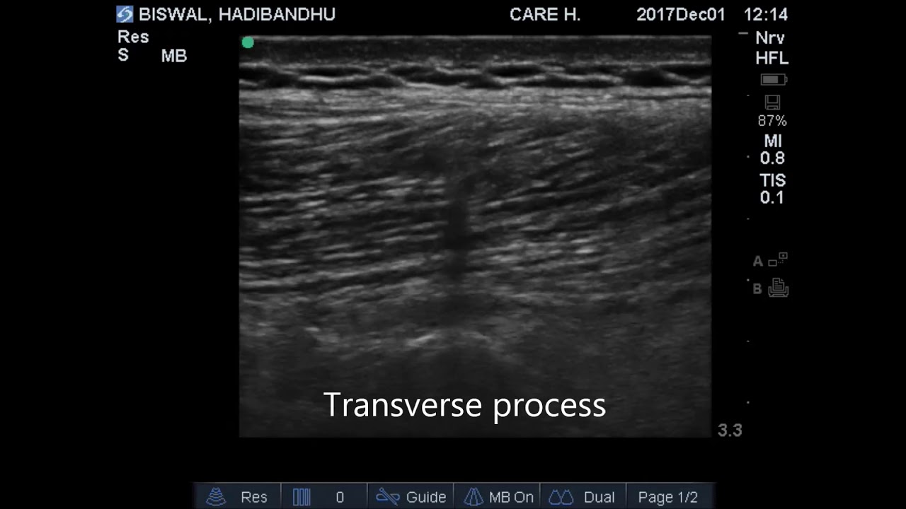 USG guided erector spinae block at lumbar level - YouTube