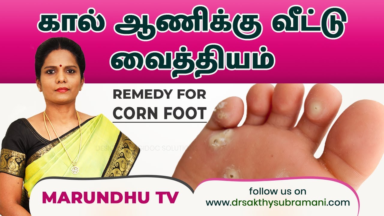 கால் ஆணிக்கு வீட்டு வைத்தியம் /Home Remedy for corn foot. - YouTube