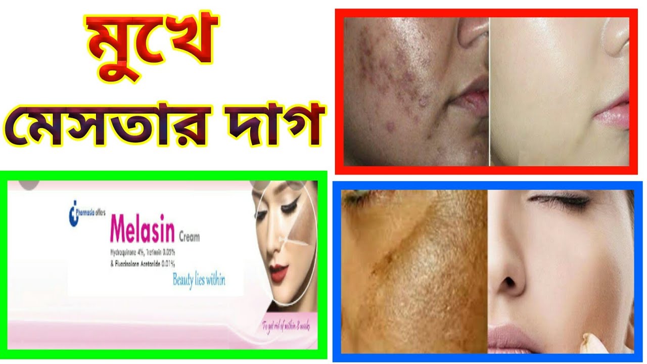 No spot cream,melatrim cream,melasin cream,মেসতার জন্য দুর্দান্ত কাজ ...
